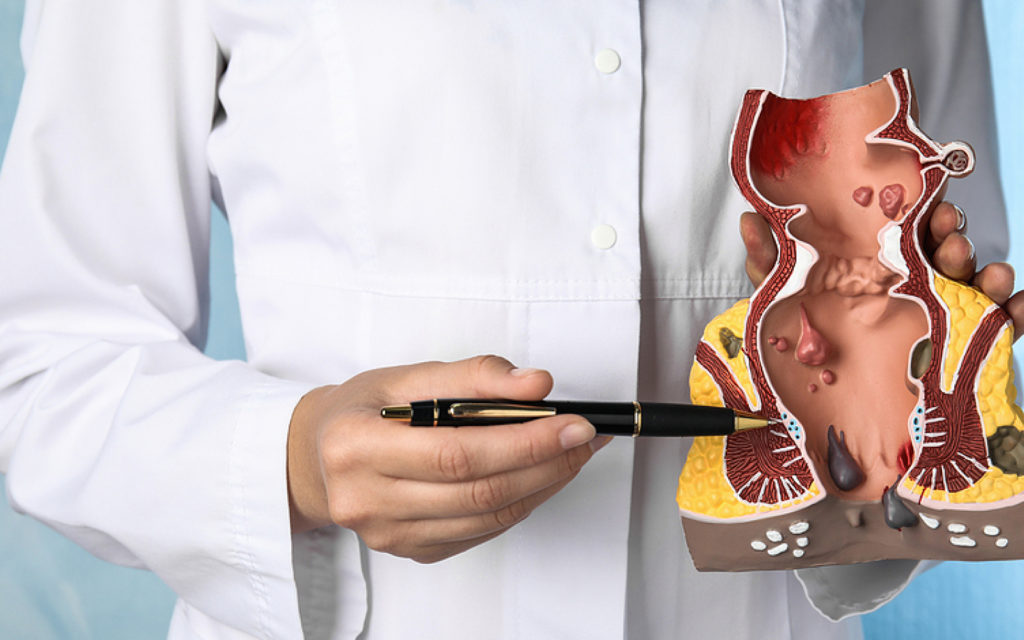 Hemoroidi: Uzroci, Simptomi I Savremene Metode Lečenja - Atlas