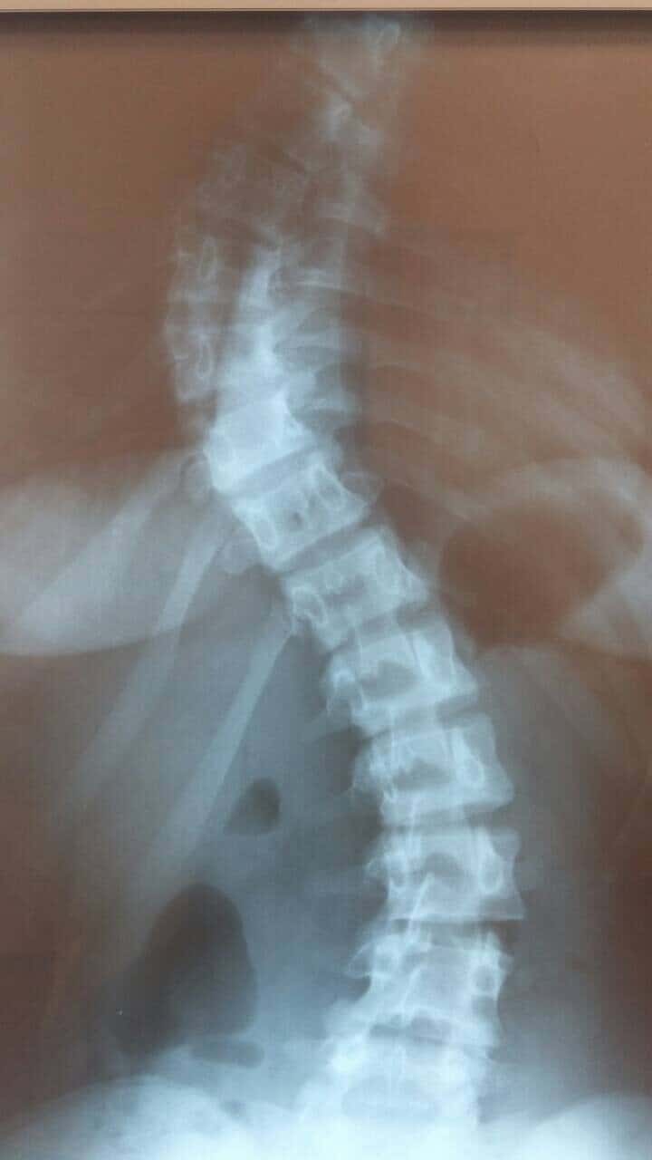 Spinal Column Surgery - Atlas
